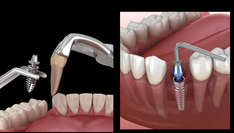 Same Day Implants - Dental Implanter