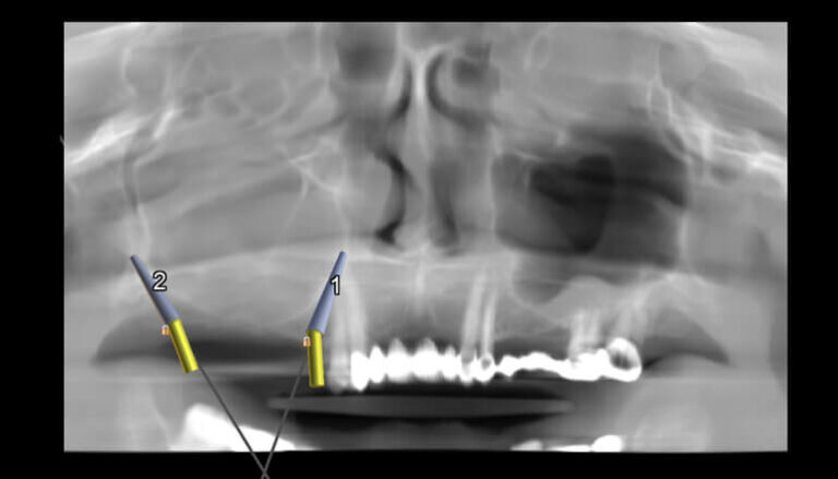 Pterygoid implants - Dental Implanter