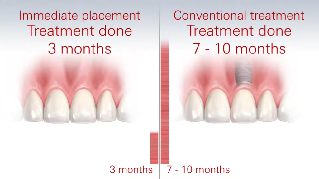 Immediate Implants vs Delayed Implants - Dental Implanter
